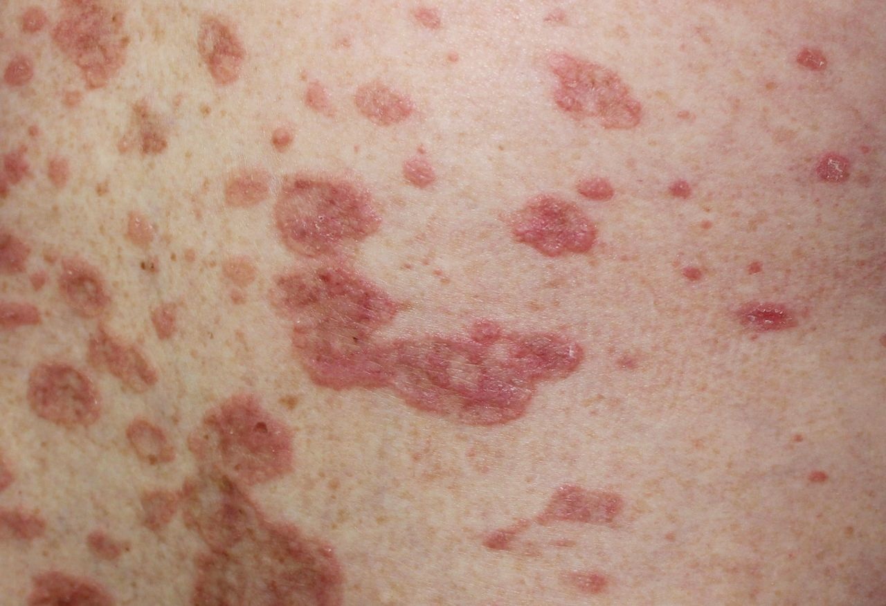 Lichen Planus