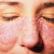 Lupus