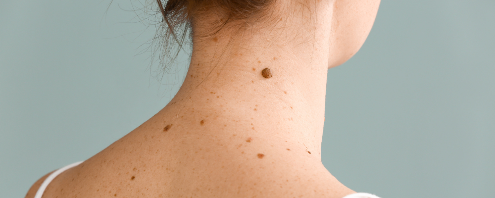 Skin Cancer Basics: Know Your ABCDEs - Dermatologist - Skincare ...